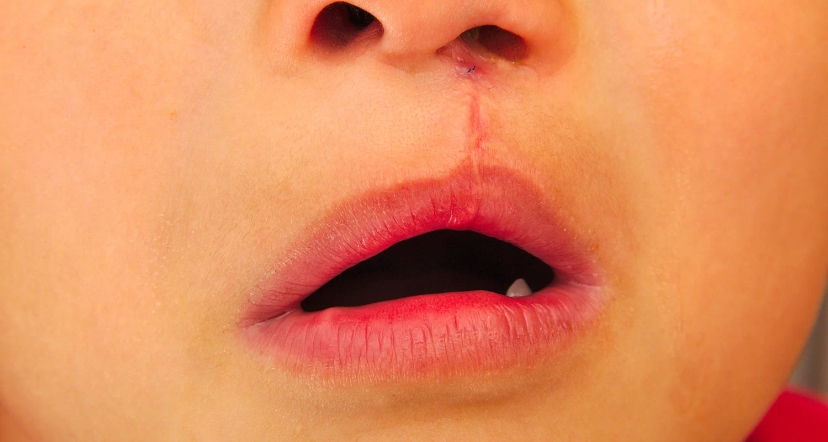 Can cleft lip and palate be detected on an ultrasound? - NowPatient