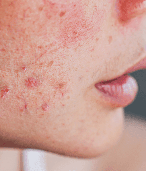 NHS Impetigo Treatment Online | Pharmacy First Eligibility Check