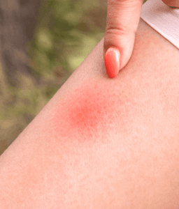 NHS Infected Insect Bites Treatment Online | Pharmacy First Eligibility ...