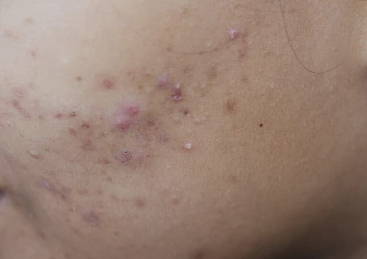 What is the New Treatment for Acne Called Aklief? - NowPatient