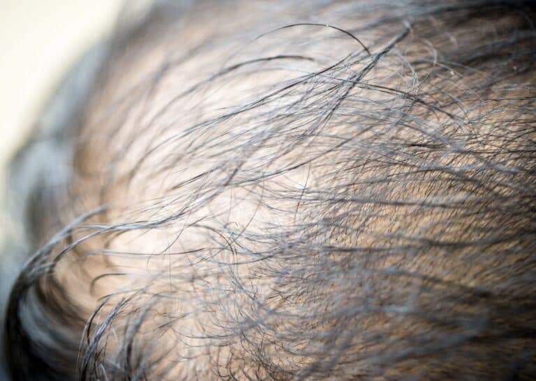 Why Is My Hair Falling Out in Clumps? - NowPatient